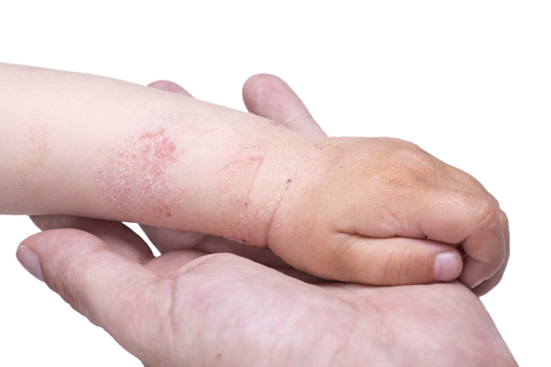 BABY & CHILD ECZEMA | baby eczema, child eczema, eczema tips and more ...
